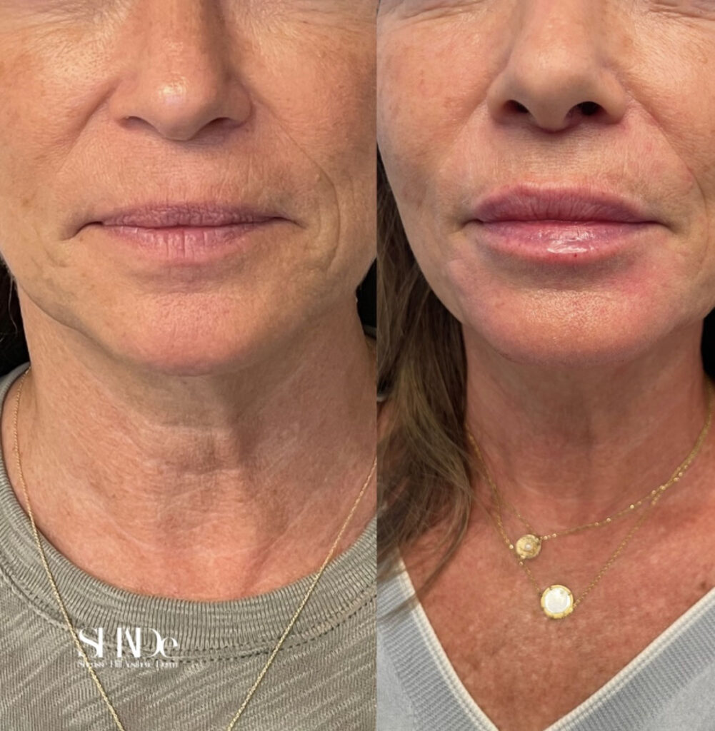 Hair Growth Factor Injections Photos | Before & After Photos