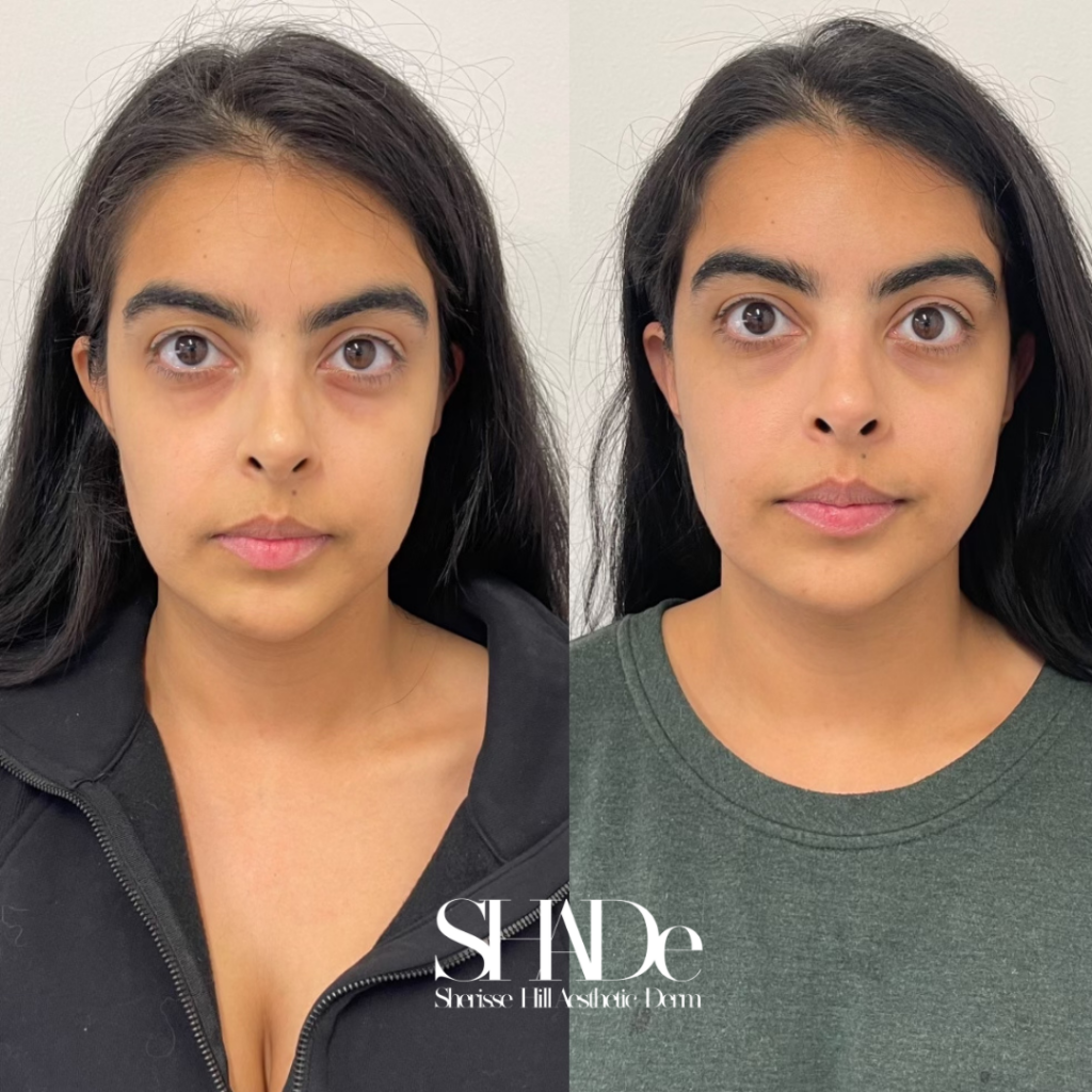 Hair Growth Factor Injections Photos | Before & After Photos